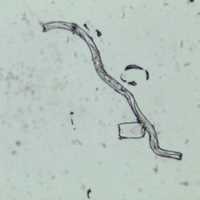 Schistosomiasis