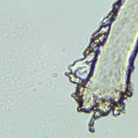 Schistosomiasis