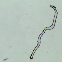 Schistosomiasis