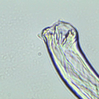 Schistosomiasis