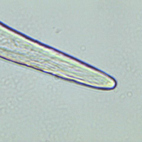 Schistosomiasis