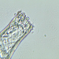 Schistosomiasis