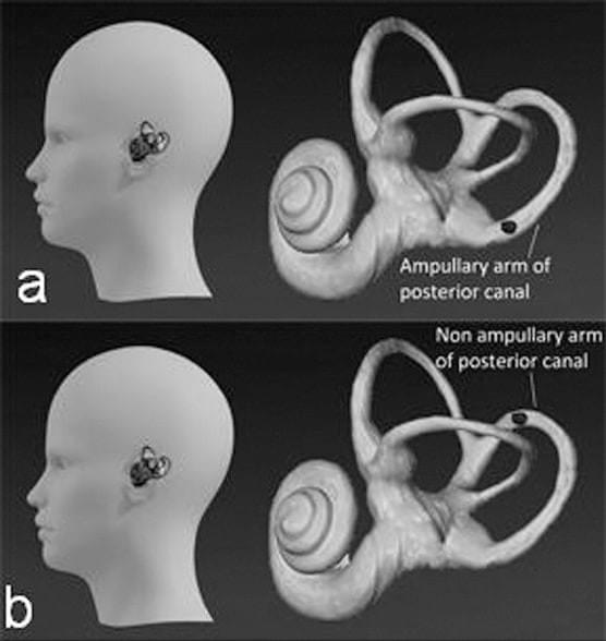 Anterior Canal BPPV: It Exists!