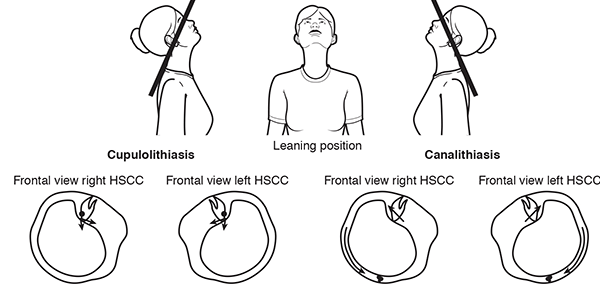 The Bow and Lean Test