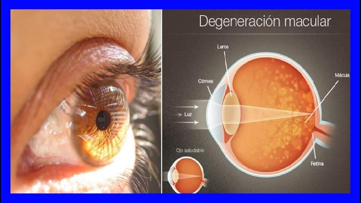Degeneración Macular
