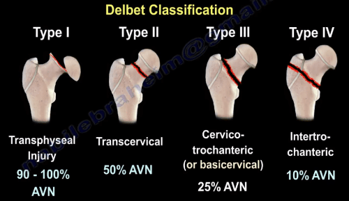 AVN of the Femoral Head- Causes, Trauma to the Hip - Healthcare ...