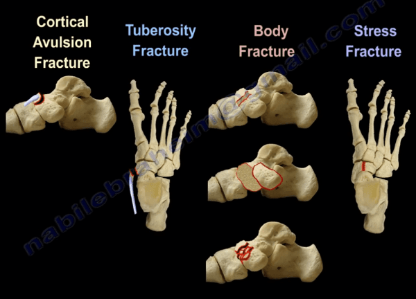 Navicular Fractures - Healthcare medicine Orthopedic Surgery ...