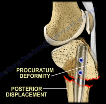 Intramedullary Nailing Proximal Tibial Fractures - medicine Healthcare ...