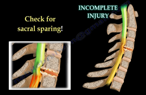 Spinal Cord Injury - Healthcare Nabil Ebraheim Orthopedic Surgery ...