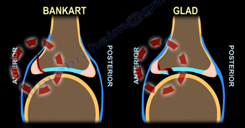 Lesions of the Shoulder- GLAD Lesion - lesions Healthcare Orthopedic ...