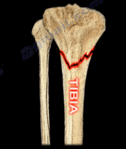Intramedullary Nailing Proximal Tibial Fractures - medicine Healthcare ...