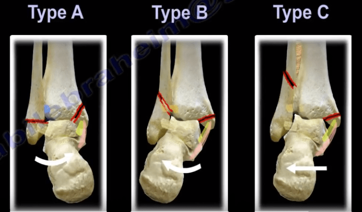 Ankle Fractures - Ankle Nabil Ebraheim Orthopedics Healthcare Fractures