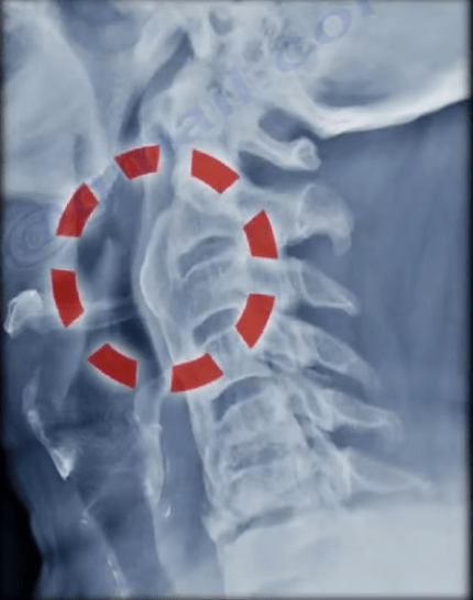 Diffuse Idiopathic Skeletal Hyperostosis DISH Orthopedic Surgery diffuse-idiopathic-skeletal-hyperostosis-dish-orthopedic-surgery