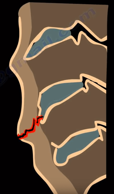 Diffuse Idiopathic Skeletal Hyperostosis - DISH Orthopedic Surgery ...
