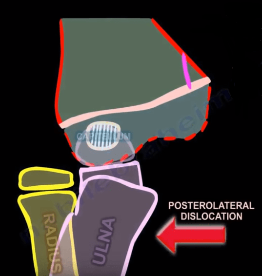 Pediatric Elbow Dislocation - Orthopedic Surgery Elbow Dislocations ...