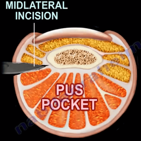 Felon - Bacteria Infections Orthopedics finger Healthcare