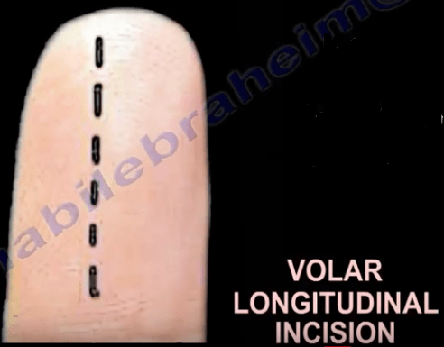 Felon - Bacteria Infections Orthopedics finger Healthcare