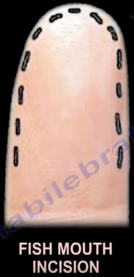 Felon - Bacteria Infections Orthopedics finger Healthcare