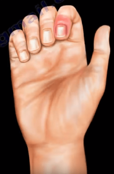 Paronychia - Orthopedics Nail Infections medicine Healthcare