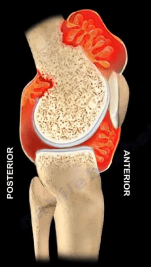 Pigmented Villonodular Synovitis (PVNS) - Healthcare Orthopedic Surgery ...