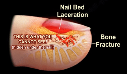 Subungual Hematoma - finger injury Fractures hematoma Orthopedic Surgery