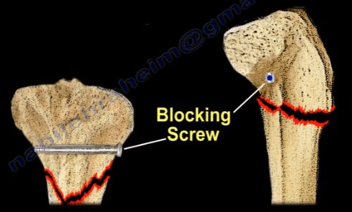 Intramedullary Nailing Proximal Tibial Fractures - medicine Healthcare ...