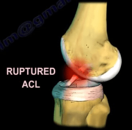 Medial Collateral Ligament Injury - Healthcare knee injury Orthopedic ...