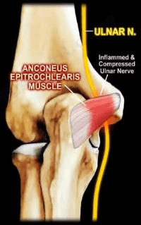 Anconeus Epitrochlearis Muscle - anatomy Medical Education medicine ...