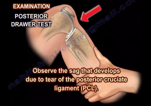 The Posterior Drawer Test - car accidents knee injury ACL knee ...