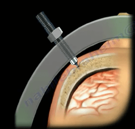 Complications Of The Halo Brace - Nabil Ebraheim medicine Orthopedic ...