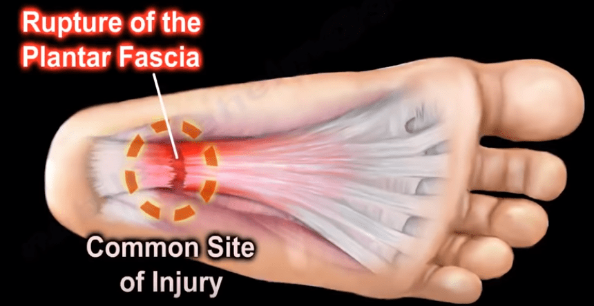Rupture of the Plantar Fascia - Orthopedic Surgery Foot pain plantar ...